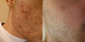 Guía isotretinoína: Beneficios, efectos adversos y rutina - HealthWithFacts